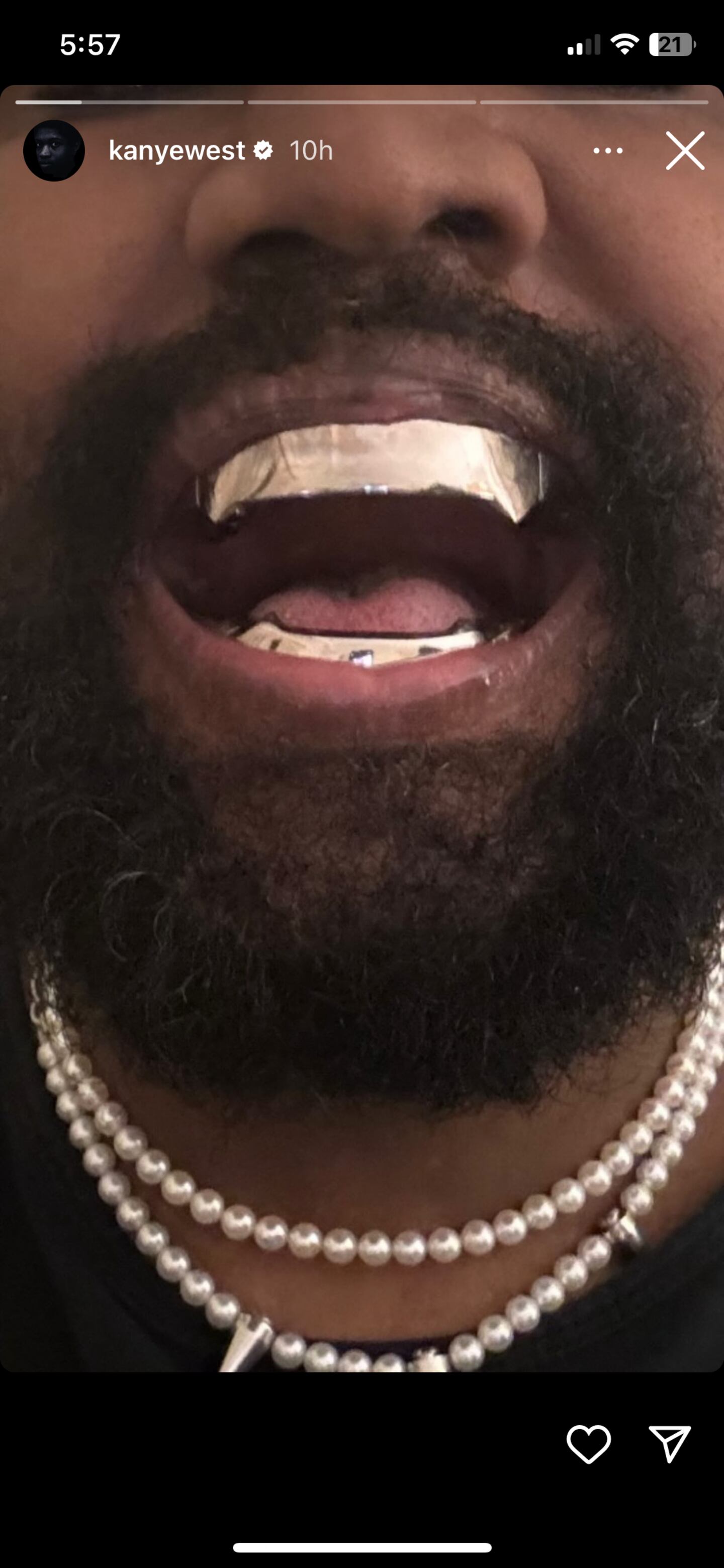 Did Kanye West have all his teeth removed and replaced with metal? - AS USA